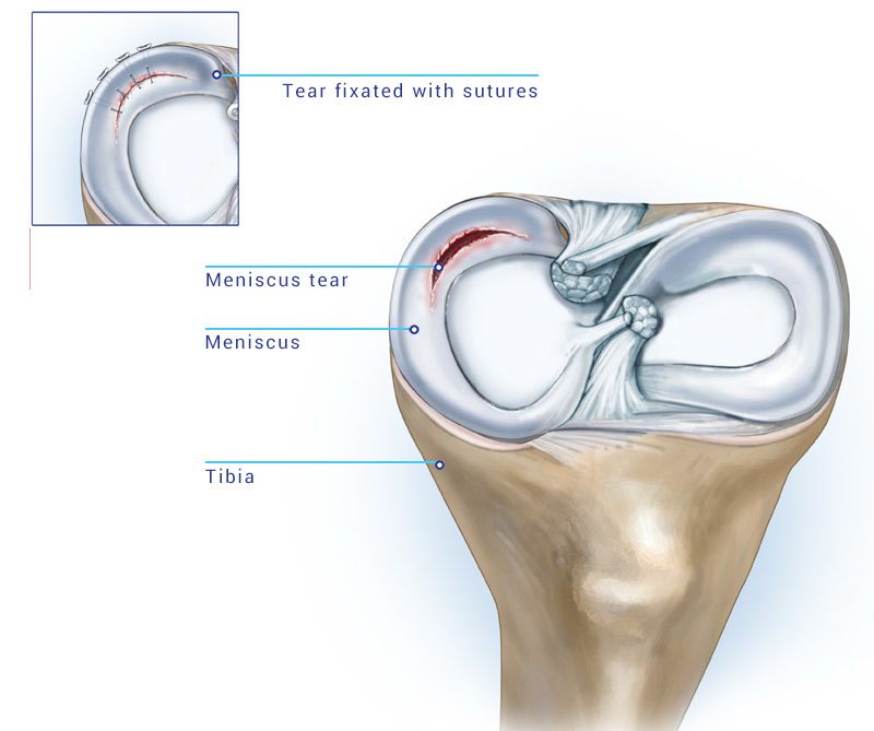 Meniscal Injury - An Medical